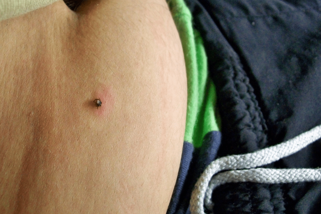 Come riconoscere puntura di zecca: morso e segni da sapere